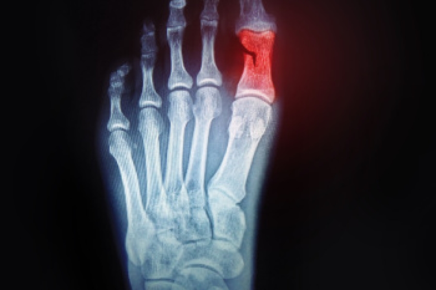 Definition and Causes of a Broken Toe